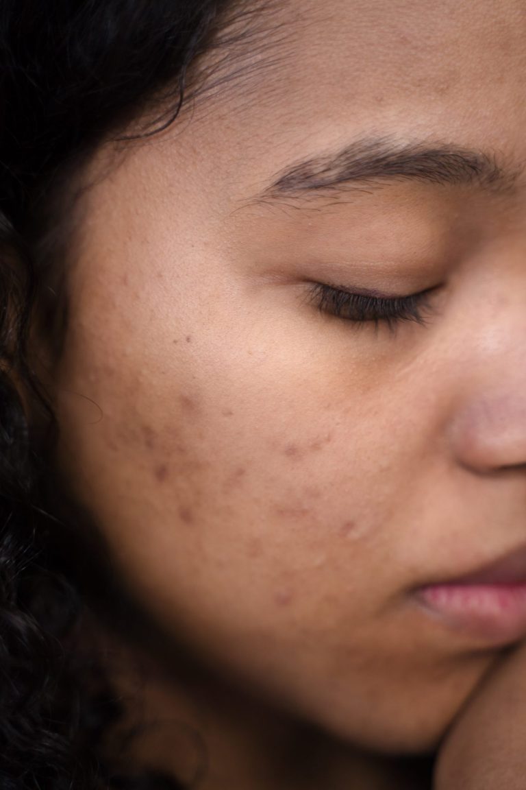 Understanding Post-inflammatory Hyperpigmentation (PIH) - The Laser Studio